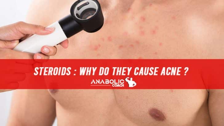 Steroids and Acne: Why do they cause Acne? - Anabolic Coach